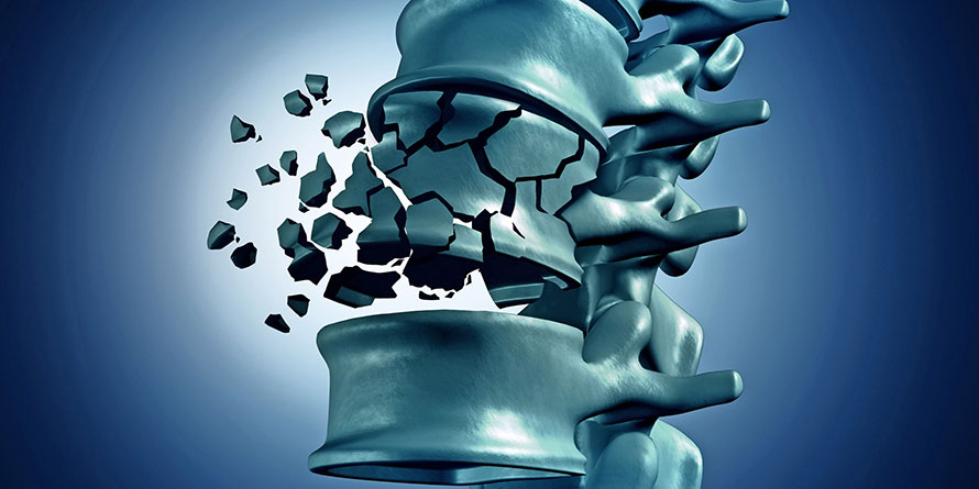 Why physical therapy is crucial after suffering bone fractures ...