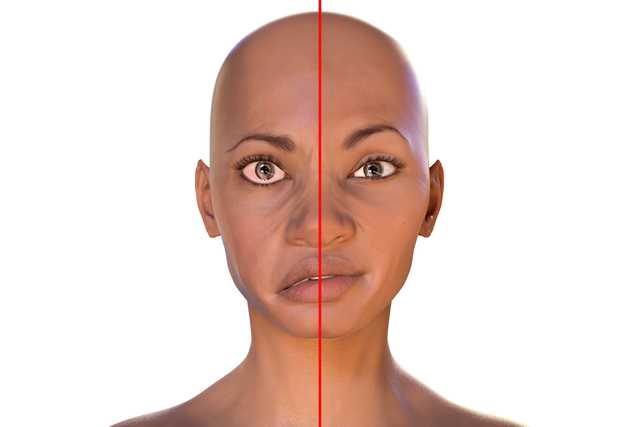 This is what you need to know about Bell’s Palsy, why it is not ...