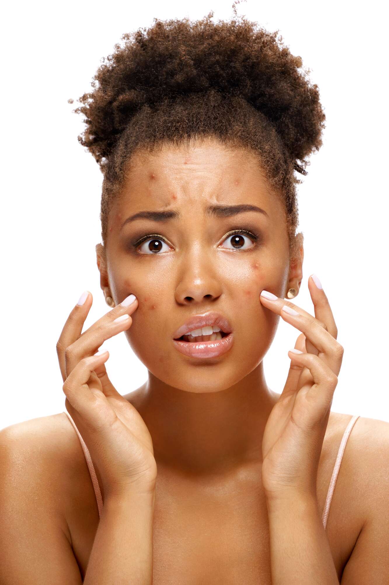 Skin outbreaks: Is it acne or just pimples? - Business Daily