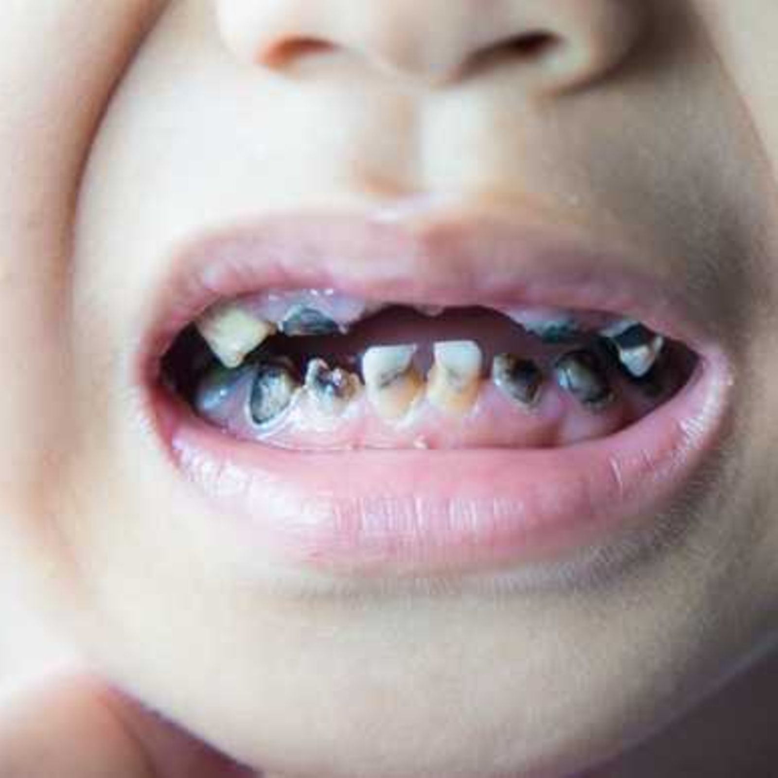 kid black teeth