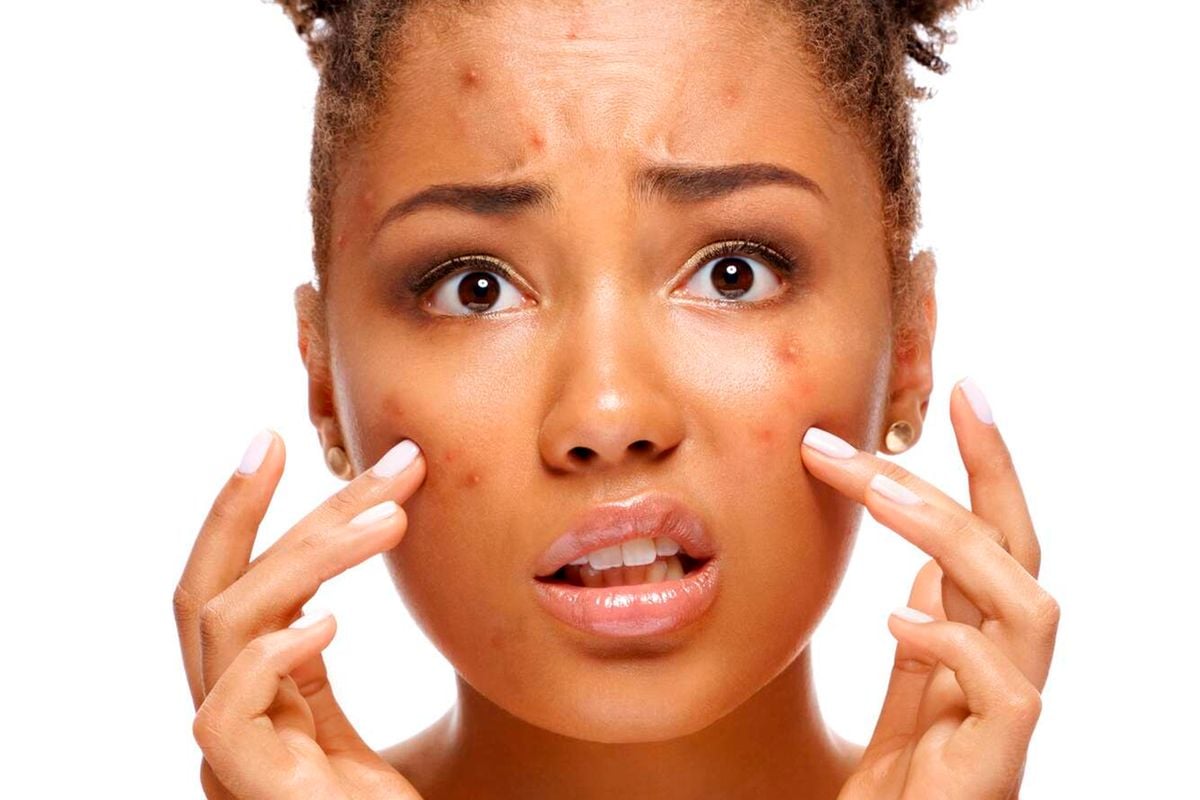 Skin outbreaks: Is it acne or just pimples? - Business Daily