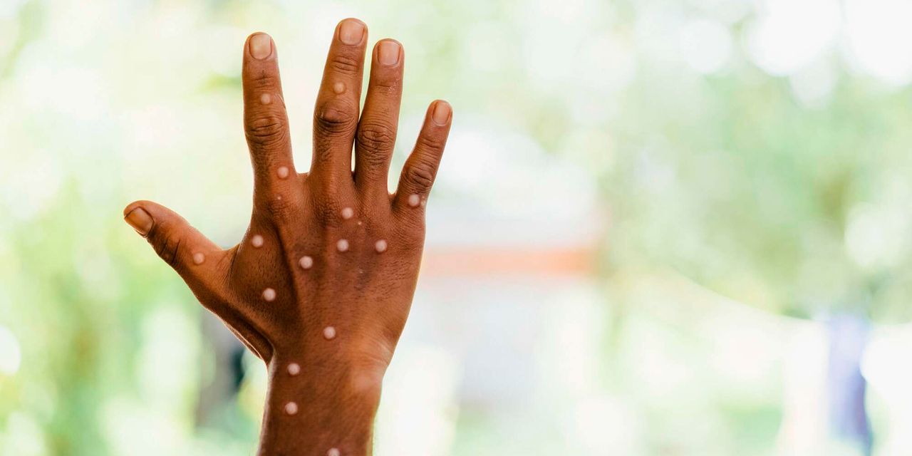 Taming Kenya’s growing M-Pox woes demands concerted action - Business Daily